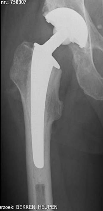 Heupprothese - Rijnland Orthopedie