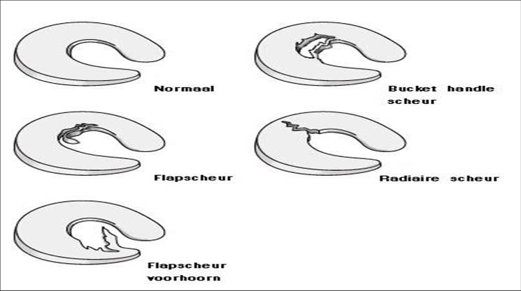 Artroscopie van de knie - Rijnland Orthopaedie