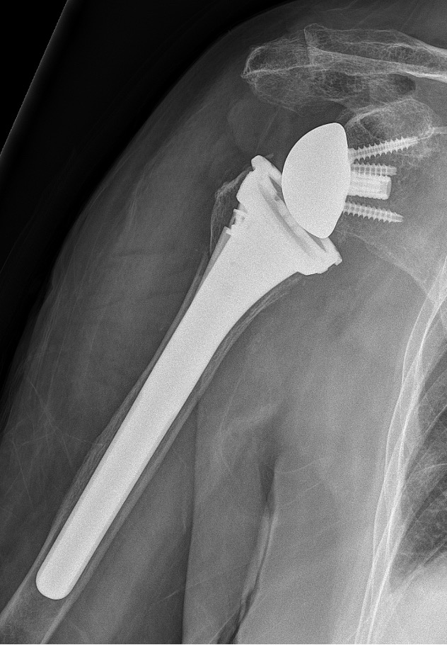 Fracturen van de kop van de bovenarm - Rijnland Orthopaedie