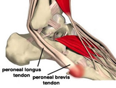 Peroneus saltans (peroneuspees schiet uit gootje) - Rijnland Orthopaedie