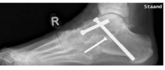 Artrose achtervoet - Rijnland Orthopaedie